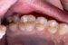 What is a Gum Line Cavity & How to Fix It? - D. Dental
